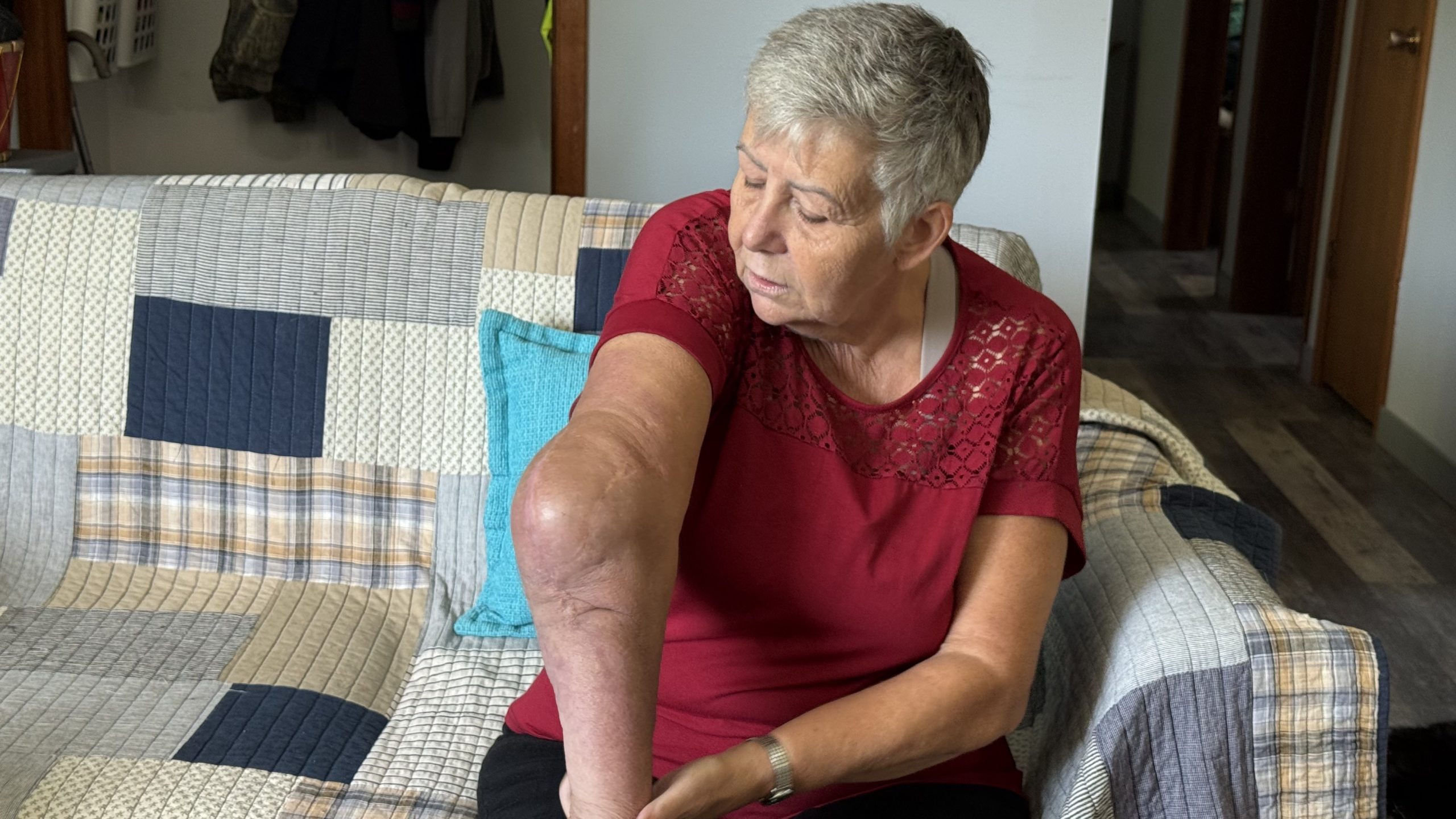 One year after latest elbow break, Winnipeg woman faces long wait for care