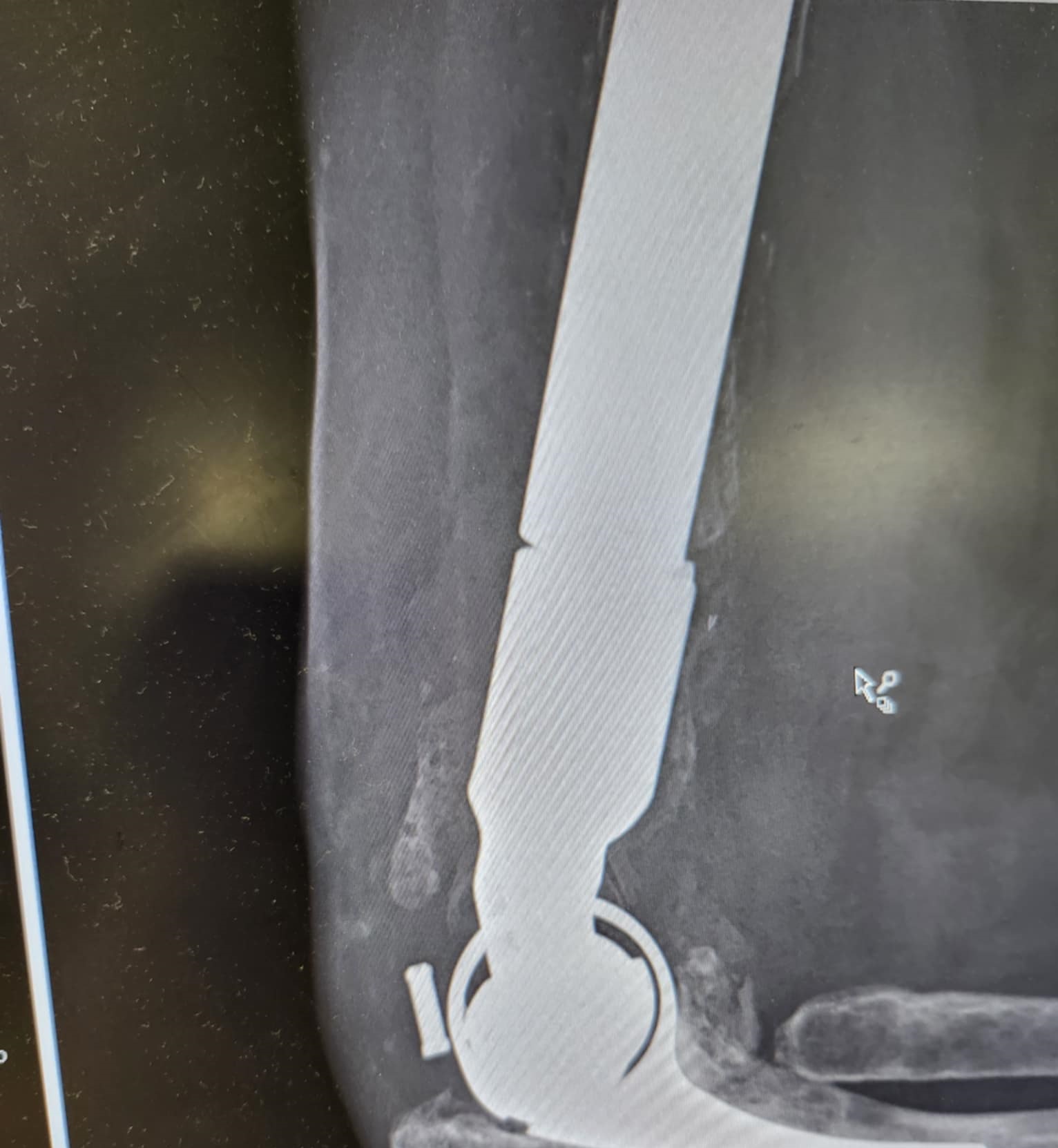 Winnipeg woman living with ‘so much pain’ waiting for yet another elbow ...